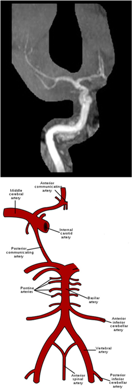 MR Brain MRA WO or WWO Neuro Protocol | OHSU